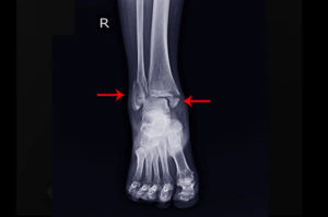 Ankle Fractures - Brick Foot and Ankle Center