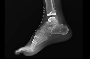 Total Ankle Replacement - Brick Foot and Ankle Center